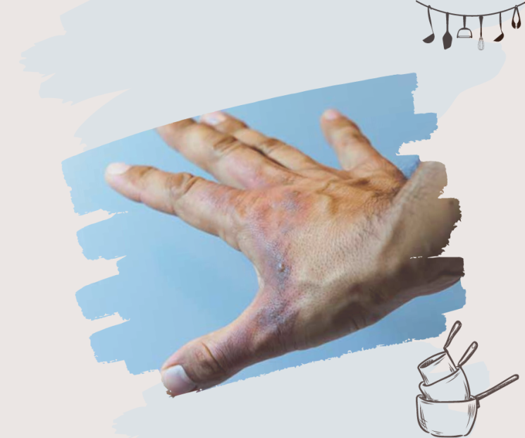 How to Treat a Burn on Hand From Hot Pan - Symptoms, First Aid and ...